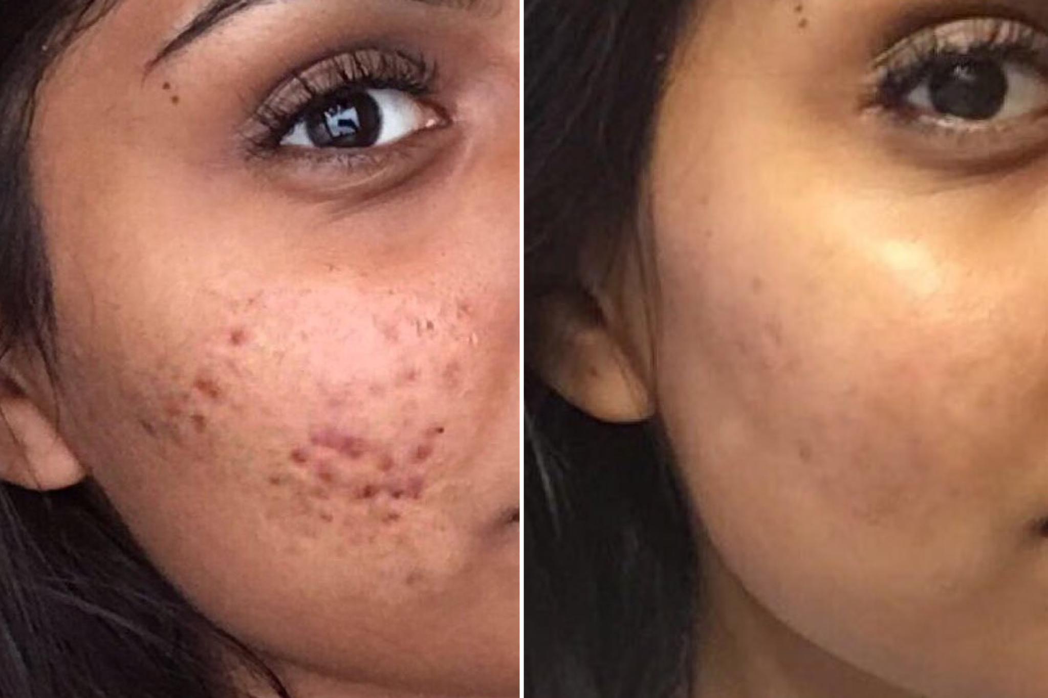 Acne Gone Before & After - Top Results of Acne Gone - Cosmetic Blog
